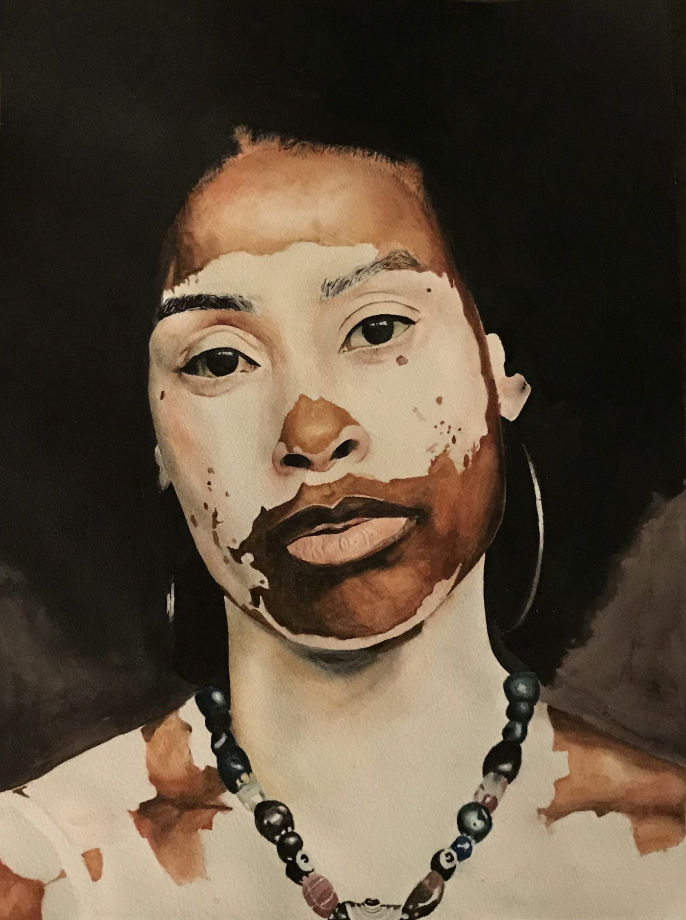 Vitiligo – BOOOOOOOM! – CREATE * INSPIRE * COMMUNITY * ART * DESIGN ...
